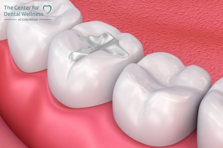 What are the benefits of teeth filling? - Dentist in Camarillo, CA ...