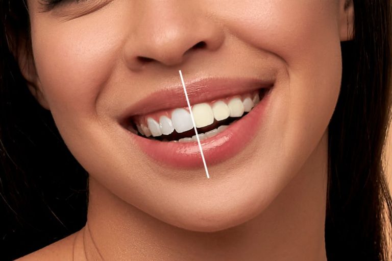 Naturally Whiten Yellow Teeth: Tips for a Brighter Smile