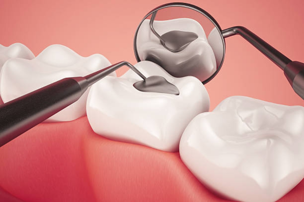 My Filling Is Sensitive: Lifespan, Causes, and Signs It Needs Replacement